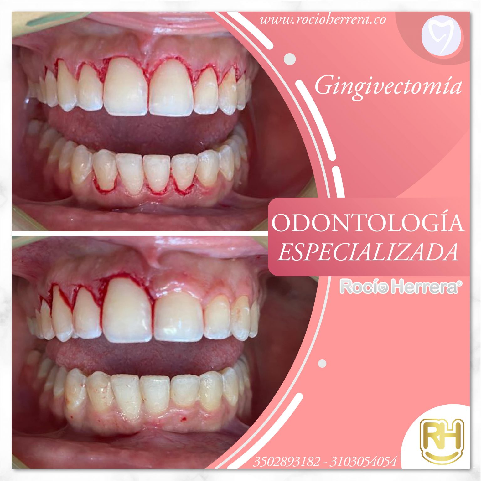 Gingivectomía - Rocio Herrera